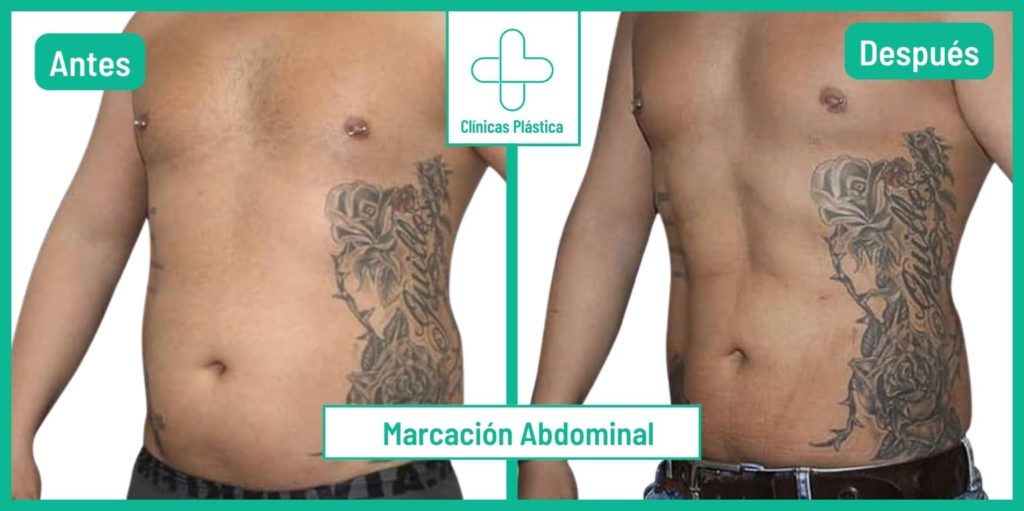 Cirugía Estética Corporal - Clinicas Cirugía plástica