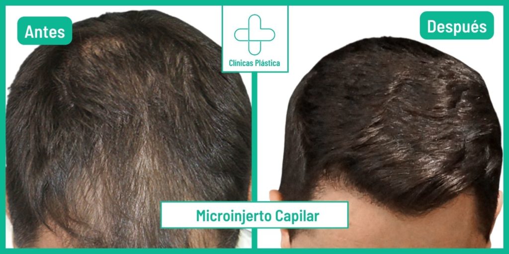 Microinjerto Capilar